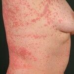 Koebner phenomenon - Altmeyers Encyclopedia - Department Dermatology