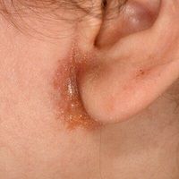 Contagious impetigo Images - Altmeyers Encyclopedia - Department ...