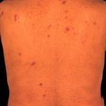 Papular dermatitis of pregnancy - Altmeyers Encyclopedia - Department ...