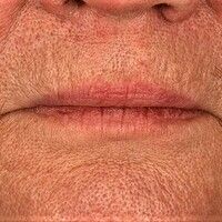 Elastose Bilder - Altmeyers Enzyklopädie - Fachbereich Dermatologie