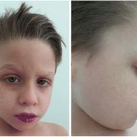 X-chromosomale retikuläre Pigmentstörung mit systemischen ...