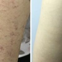 TEMPI syndrome Bilder - Altmeyers Enzyklopädie - Fachbereich Dermatologie