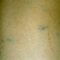 Blue-Rubber-Bleb-Naevus-Syndrom Images - Altmeyers Encyclopedia ...