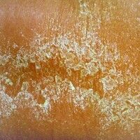 Staphylococcal scalded skin syndrome Images - Altmeyers Encyclopedia ...