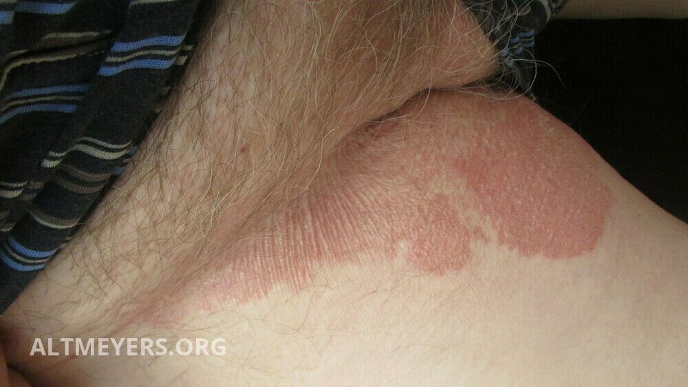 Cutaneous Erythrasma