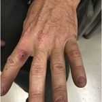 Cutaneous botryomycosis - Altmeyers Encyclopedia - Department Dermatology