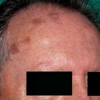 Facial granuloma Images - Altmeyers Encyclopedia - Department Dermatology