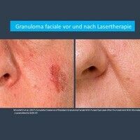 Facial granuloma Images - Altmeyers Encyclopedia - Department Dermatology