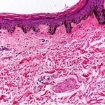Pityriasis rotunda - Altmeyers Encyclopedia - Department Dermatology