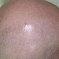 Spiradenom Bilder - Altmeyers Enzyklopädie - Fachbereich Dermatologie
