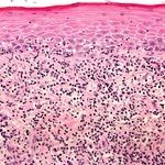 Chronic ulcerative stomatitis - Altmeyers Encyclopedia - Department ...