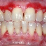 Chronic ulcerative stomatitis - Altmeyers Encyclopedia - Department ...