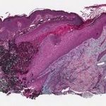 Elastosis perforans serpiginosa - Altmeyers Enzyklopädie - Fachbereich ...