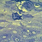 Spongiform pustule - Altmeyers Encyclopedia - Department Dermatology
