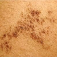 Comedonal Epidermolytic Nevus Images - Altmeyers Encyclopedia ...
