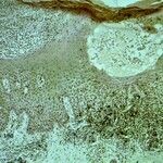 Pustular psoriasis palmaris et plantaris - Altmeyers Encyclopedia ...