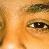 Verruca filiformis Bilder - Altmeyers Enzyklopädie - Fachbereich ...