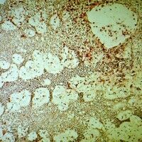 Dyshidrosis Images - Altmeyers Encyclopedia - Department Dermatology
