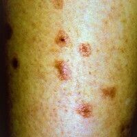 Porokeratosis superficialis disseminata actinica Images - Altmeyers ...