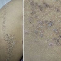 Linear porokeratosis Images - Altmeyers Encyclopedia - Department ...