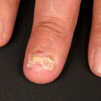 Onychomykose (Übersicht) Bilder - Altmeyers Enzyklopädie - Fachbereich ...