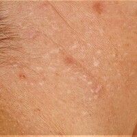 Anetodermie Bilder - Altmeyers Enzyklopädie - Fachbereich Dermatologie