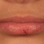 Atopic cheilitis - Altmeyers Encyclopedia - Department Dermatology