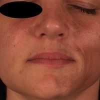 Parry Romberg syndrome Images - Altmeyers Encyclopedia - Department ...