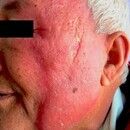 Tropic ulcer - Altmeyers Encyclopedia - Department Vascular medicine