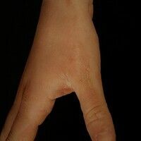Lateral nevus verrucosus unius lateralis Images - Altmeyers ...