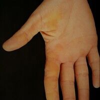 Lateral nevus verrucosus unius lateralis Images - Altmeyers ...