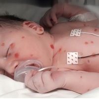 Kongenitale selbstheilende Histiozytose, lokalisiert)(Hashimoto ...