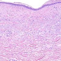 Diffuse normolipemic plane xanthoma Images - Altmeyers Encyclopedia ...