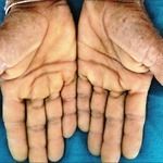 Tripe palms - Altmeyers Encyclopedia - Department Dermatology