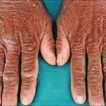 Tripe palms - Altmeyers Encyclopedia - Department Dermatology