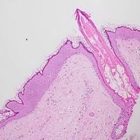 Cutaneous follicular hyperkeratotic spicules Bilder - Altmeyers ...