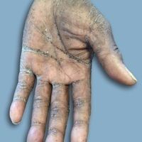 Spiny keratoderma of the palms and soles Images - Altmeyers ...