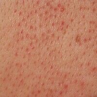 Follicular mucinosis Images - Altmeyers Encyclopedia - Department ...