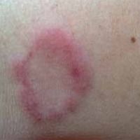 Erythema migrans arciforme et palpabile Bilder - Altmeyers Enzyklopädie ...