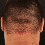 Acne keloidalis nuchae - Altmeyers Encyclopedia - Department Dermatology