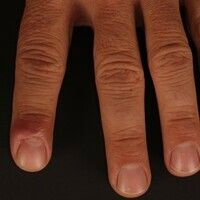 Panaritium Bilder - Altmeyers Enzyklopädie - Fachbereich Dermatologie