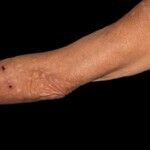 Prurigo simplex subacuta - Altmeyers Enzyklopädie - Fachbereich ...