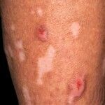 Prurigo simplex subacuta - Altmeyers Encyclopedia - Department Dermatology