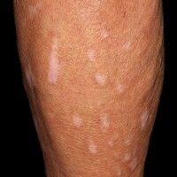 Prurigo simplex subacuta Bilder - Altmeyers Enzyklopädie - Fachbereich ...