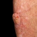 Prurigo simplex subacuta - Altmeyers Enzyklopädie - Fachbereich ...