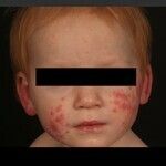 Gianotti-Crosti-Syndrom - Altmeyers Enzyklopädie - Fachbereich Dermatologie