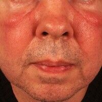 Erysipel Bilder - Altmeyers Enzyklopädie - Fachbereich Dermatologie