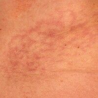 Erythema e calore Bilder - Altmeyers Enzyklopädie - Fachbereich ...