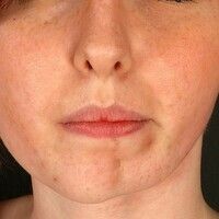 Parry Romberg syndrome Images - Altmeyers Encyclopedia - Department ...