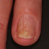 Nagelerkrankungen (Übersicht) Bilder - Altmeyers Enzyklopädie ...